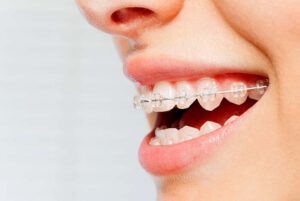 Self-Ligating Braces Cost and Benefits