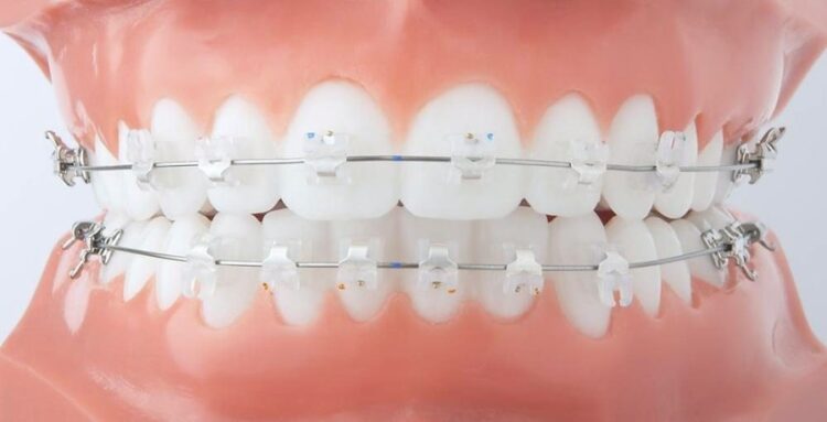 Self Ligating Braces Cost And Benefits