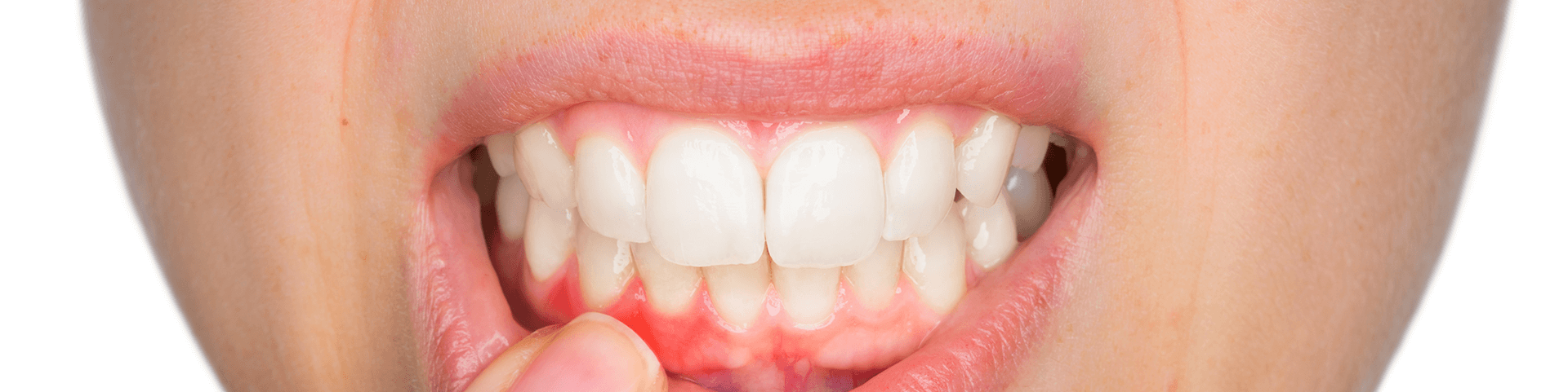 Causes Of Bleeding Gums And How To Prevent Them