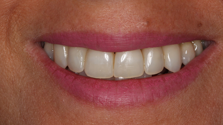 Black Triangle Teeth: How to Fix Black Triangle Between Teeth