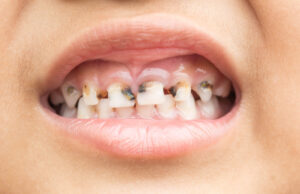 Black Teeth: Symptoms, Causes, Stains and Treatment