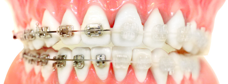 How much does Ceramic braces cost UK? Ceramic treatment cost London