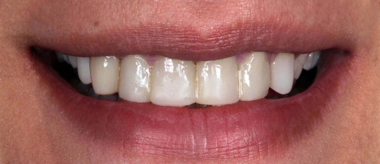 Emax Veneers London: Enhance Dental Aesthetics with E-max Veneers