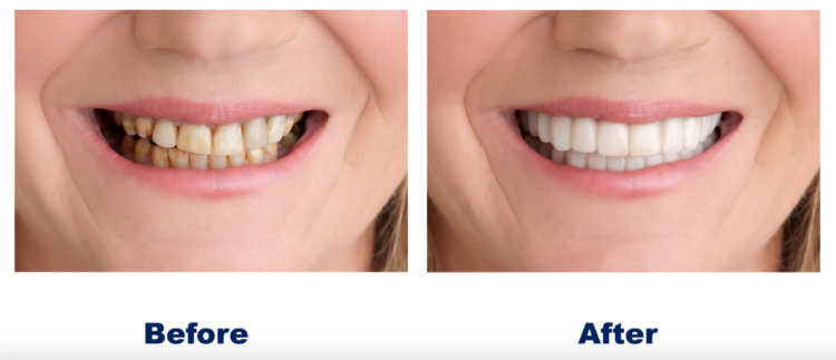 What is Snap-on Smile: Benefits, Procedure, Cost, Durability